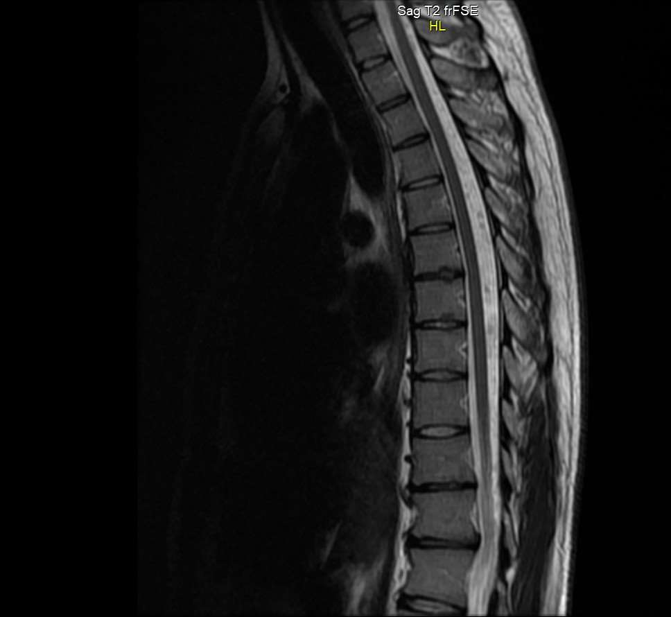 Torakal Mr Hakkında Fikir Alabileceğim, (Sırt Fıtığı) Radyoloji ...